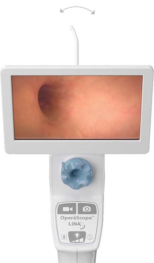 LiNA OperåScope™ Single-Use Operative Hysteroscopy System – LiNA ...
